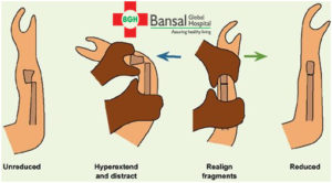 Treatment of fracture without surgery by our expert Dr Suresh Bansal