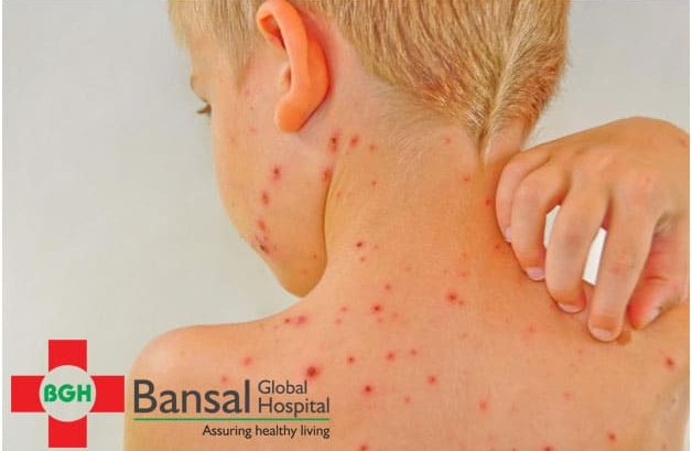 Caring Guide for Chicken Pox Patients